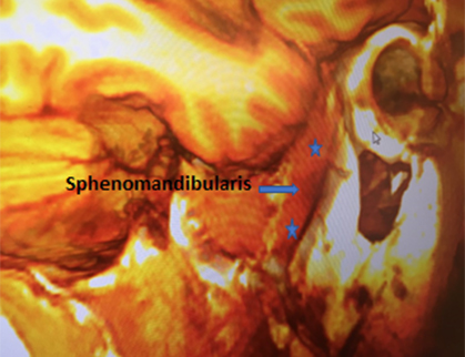 Discovery of a Previously Unknown and Unappreciated Facial Muscle